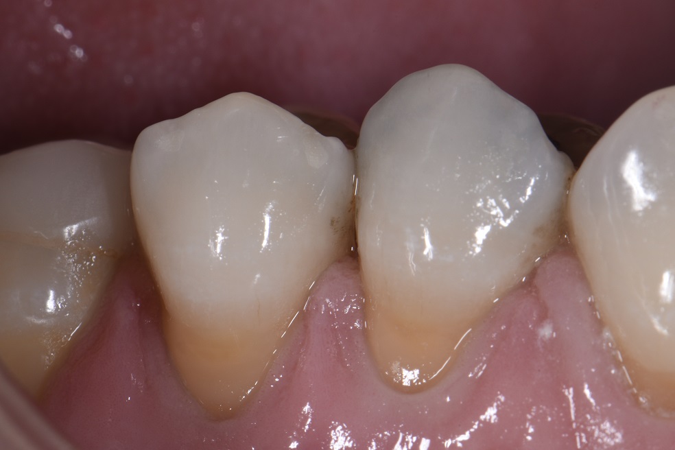 Class V Restorations Done Invisibly