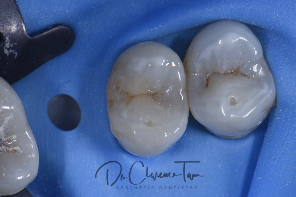 Clean Line Restoration for a Second Premolar
