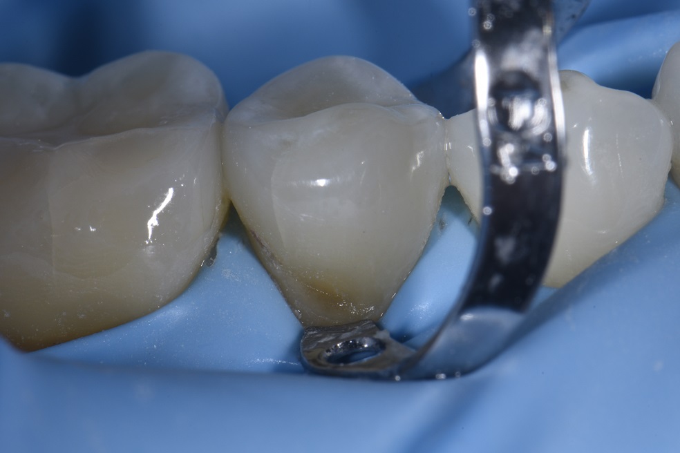 Reversing Wear on Root Surfaces with Composite Bonding