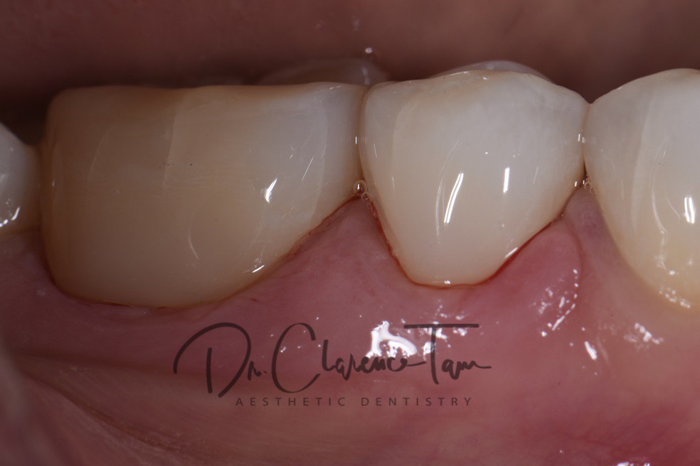 Reversing Wear on Root Surfaces with Composite Bonding