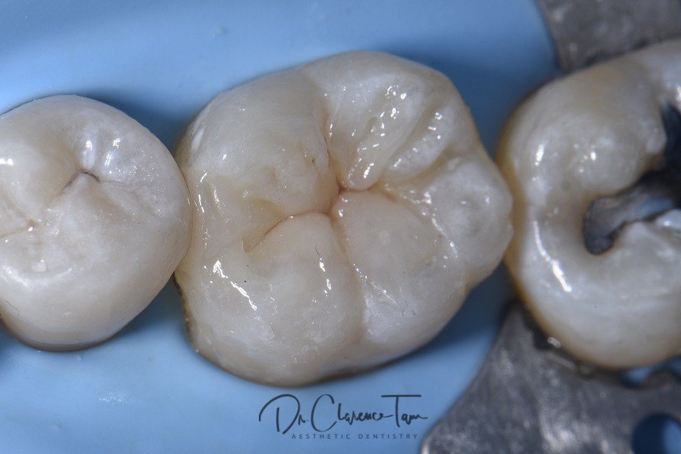 Old Amalgam Restorations Biomimetically Replaced