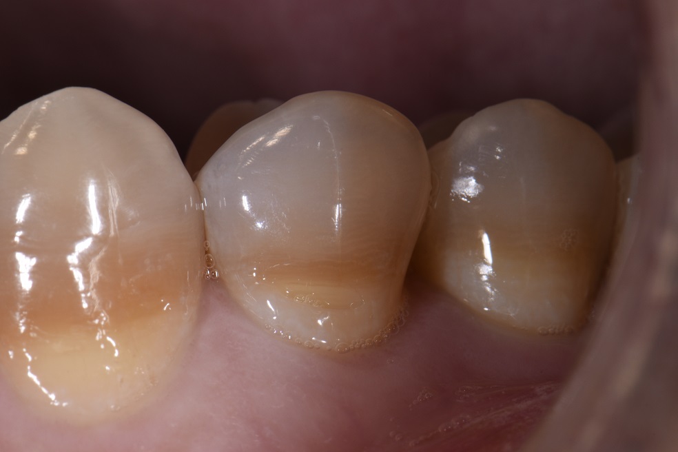Class V restorations on tetracycline stained teeth