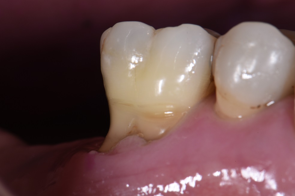 Root lesions restored