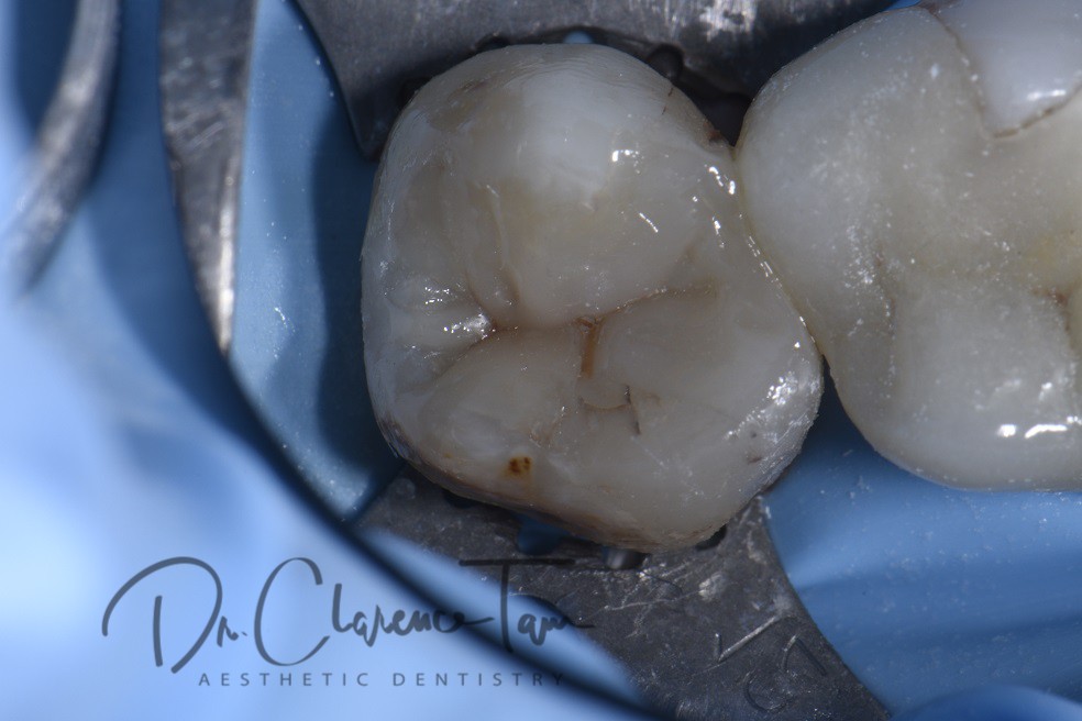 Partial replacement of old composite fillings