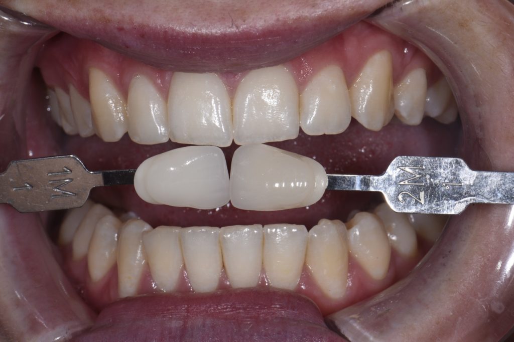 Predictable results in whitening teeth