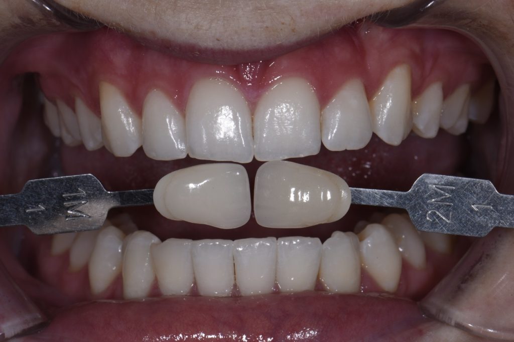 Predictable results in whitening teeth