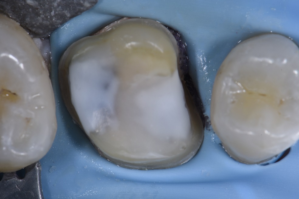 Natural Looking Crowns and Restorative Dentistry