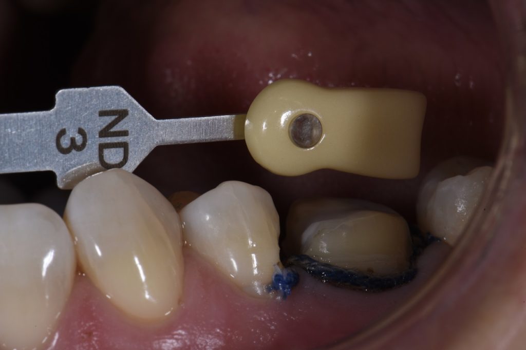 Natural Looking Crowns and Restorative Dentistry