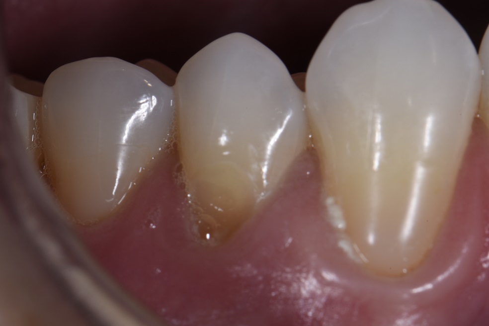 First Aid for Cervical Abrasion Lesions