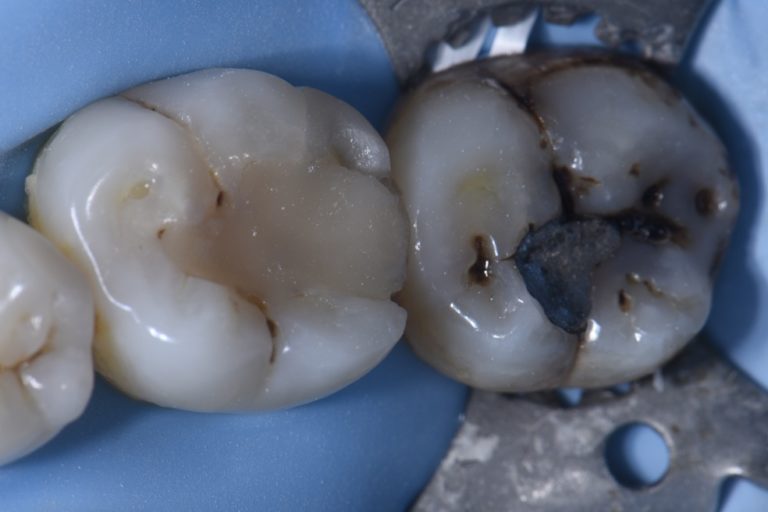 Deep cavities and fillings that copy nature