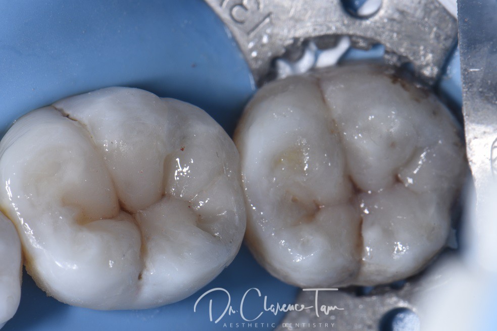 Deep cavities and fillings that copy nature