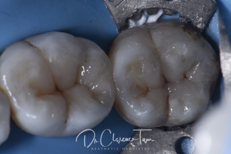 Deep cavities and fillings that copy nature