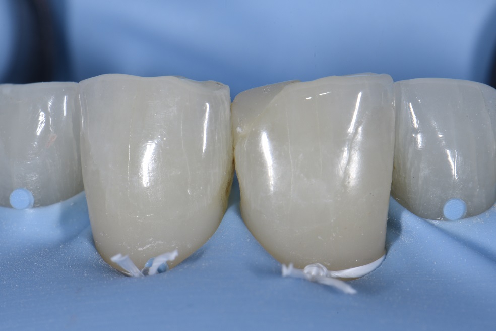Minimal Resin Bonding to Generate Better Symmetry