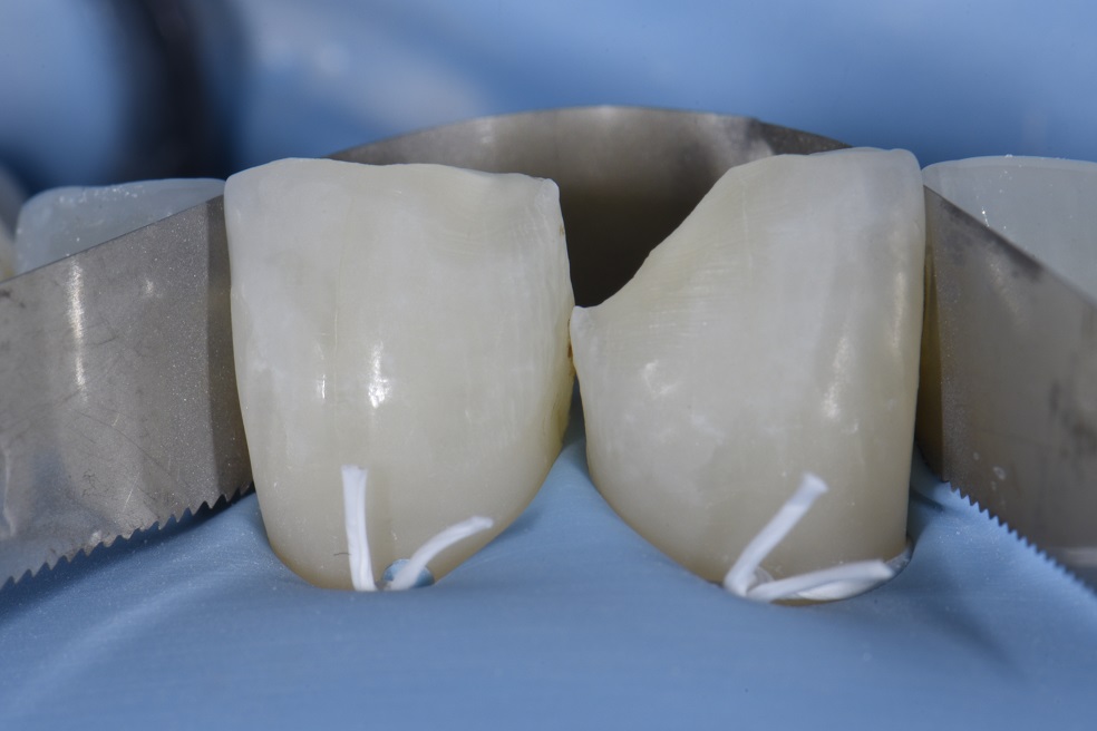 Minimal Resin Bonding to Generate Better Symmetry