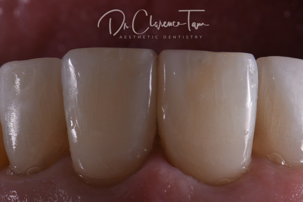 Minimal Resin Bonding to Generate Better Symmetry