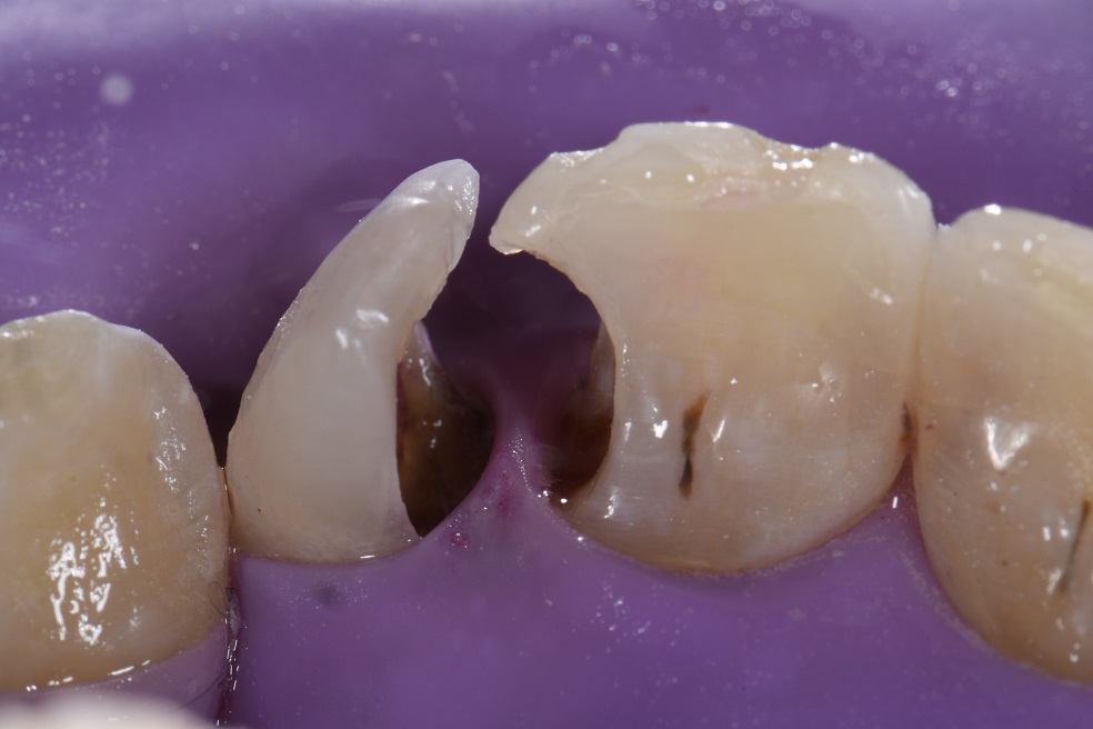 Clinicians Choice Evanesce to restore extensive dental decay