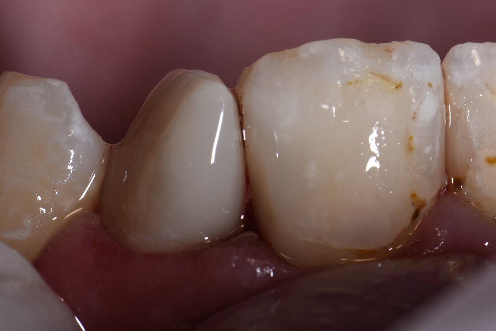 Clinicians Choice Evanesce to restore extensive dental decay