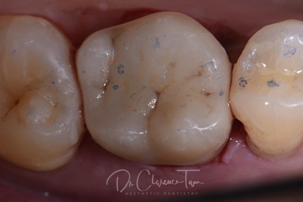 Natural Looking Crowns and Restorative Dentistry