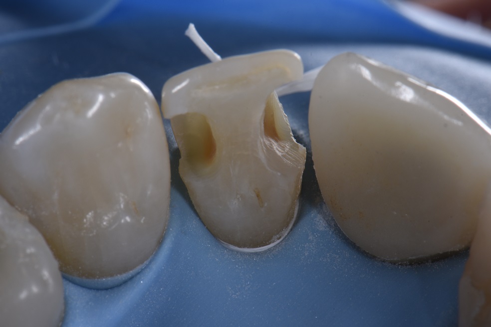 Class III Restorations with Kulzer Venus Pearl