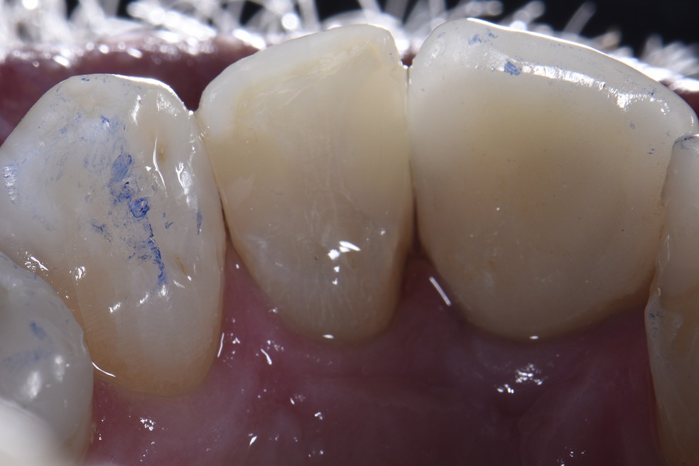 Class III Restorations with Kulzer Venus Pearl
