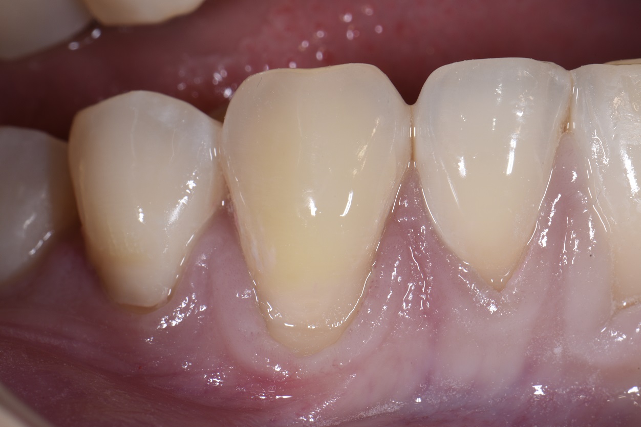 Cervical Abrasion Lesions Restored with GC Essentia U