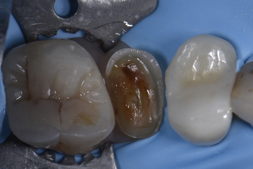 Ultradent Unicore Post