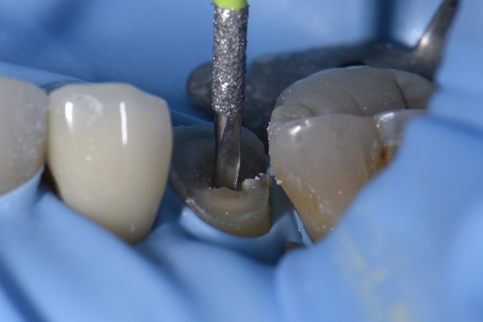 Ultradent Unicore Post