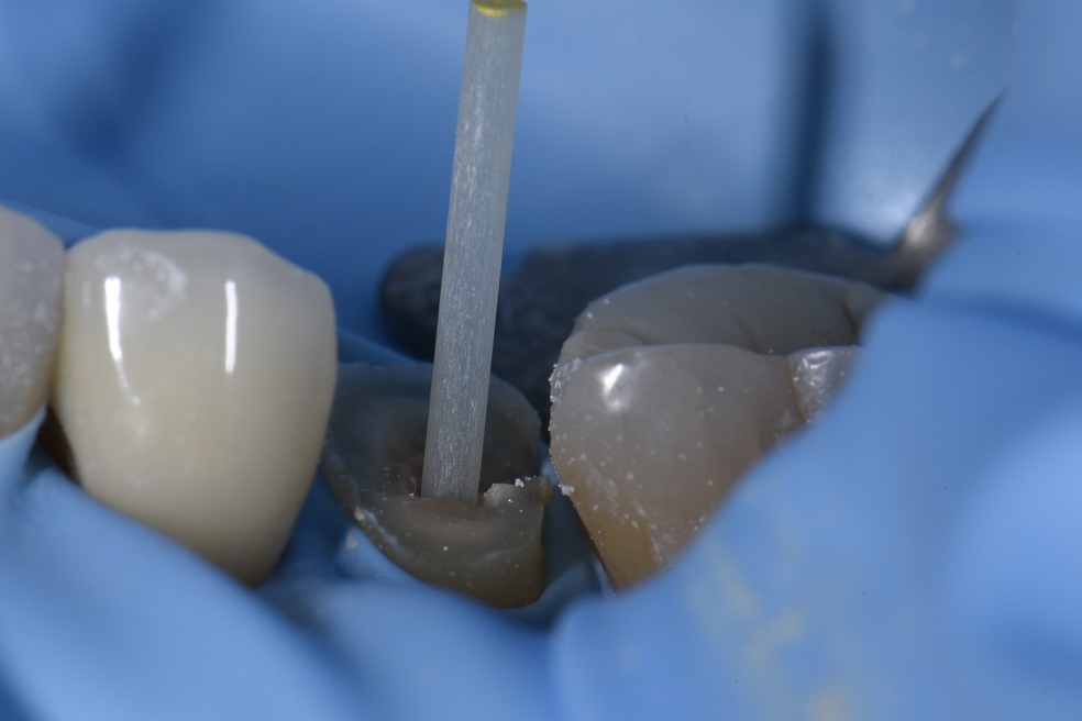 Ultradent Unicore Post