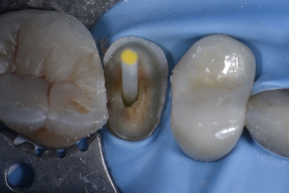 Ultradent Unicore Post