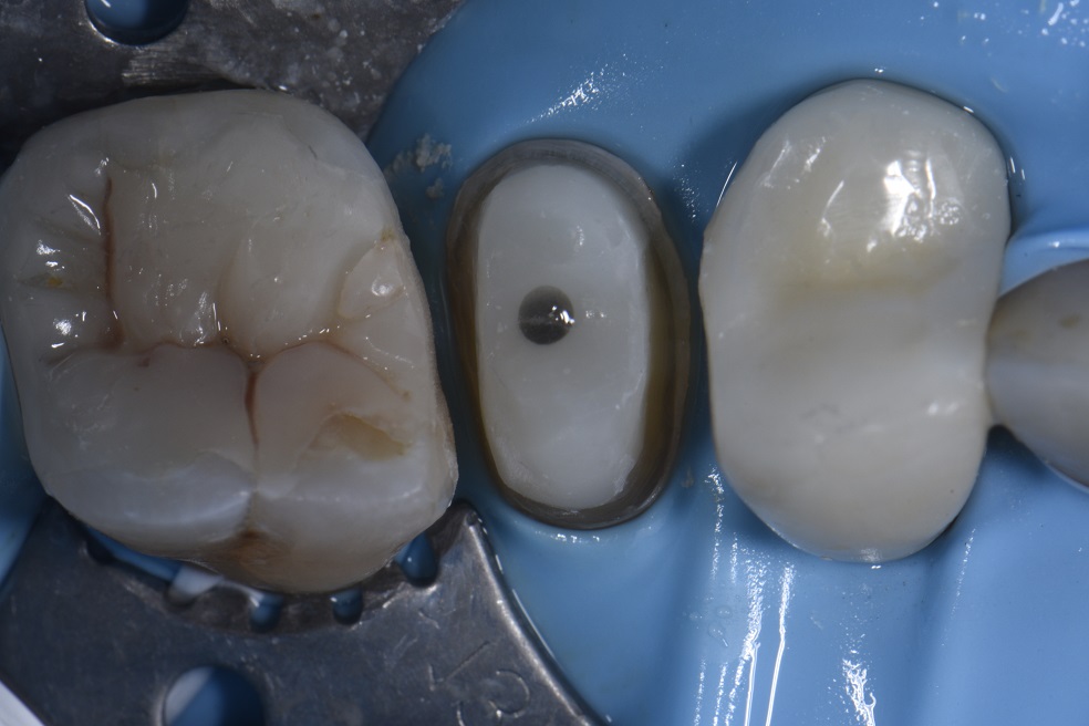 Ultradent Unicore Post