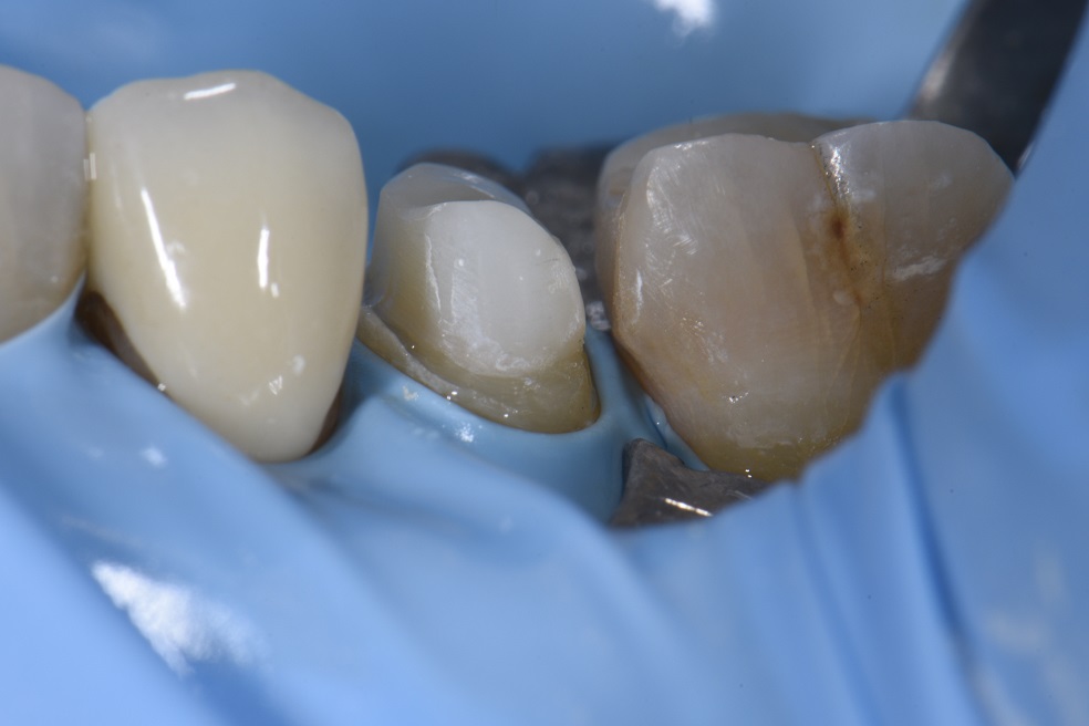 Ultradent Unicore Post