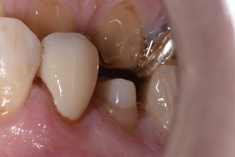 Ultradent Unicore Post