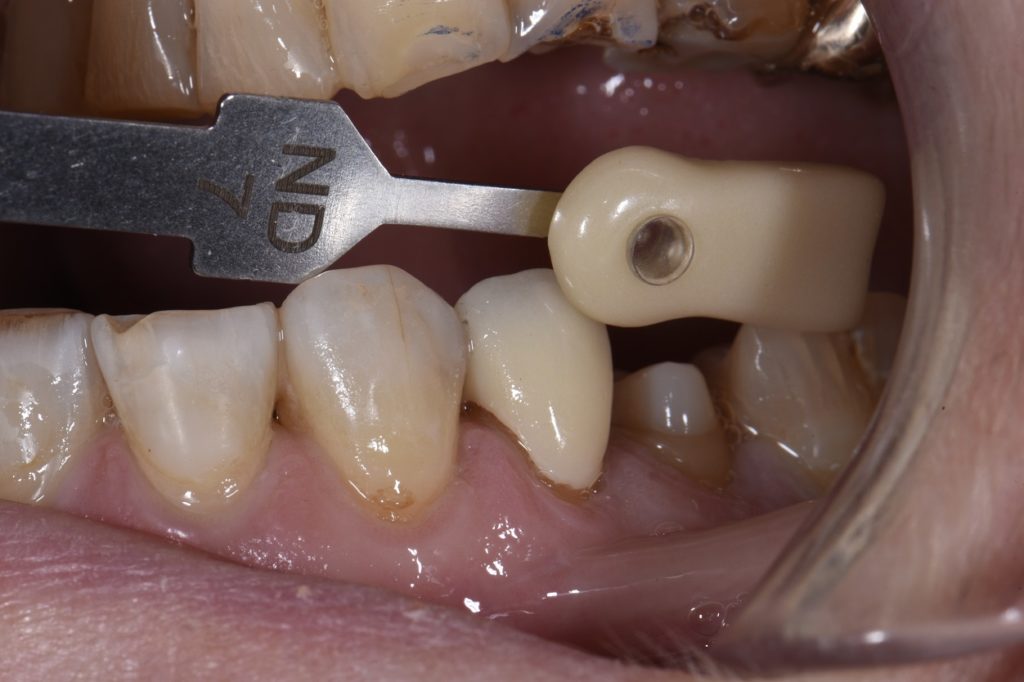 Ultradent Unicore Post