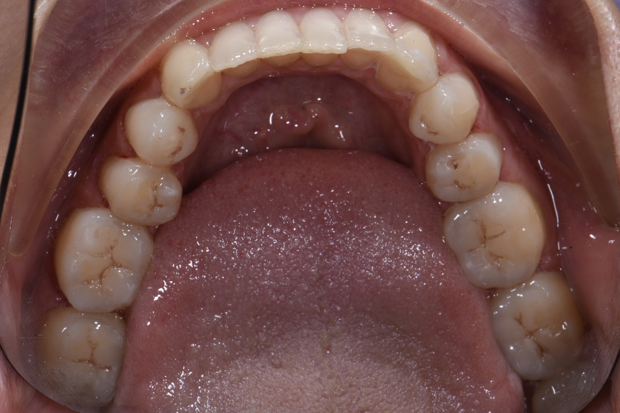 Bulimia Teeth Before And After