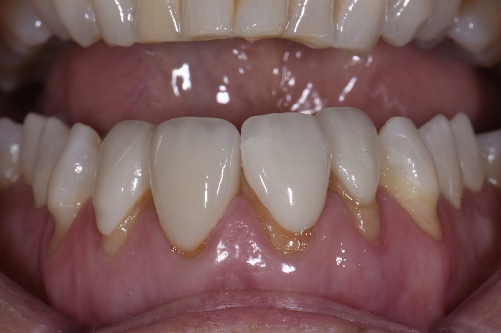 Modifying the Pink before Executing the White