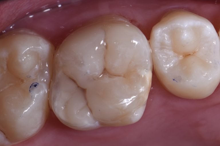 Managing A Hypomineralized Molar With Direct Resin