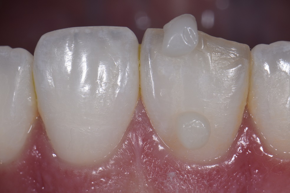 Class IV fracture freehand repair with Kerr Harmonize composite resin