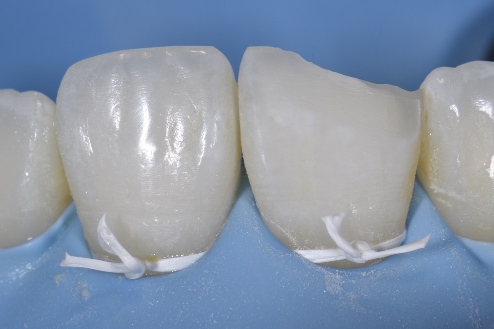 Class IV fracture freehand repair with Kerr Harmonize composite resin