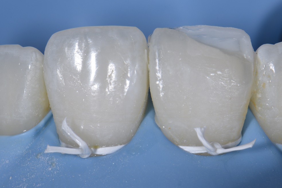 Class IV fracture freehand repair with Kerr Harmonize composite resin