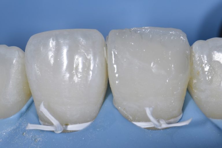 Class IV fracture freehand repair with Kerr Harmonize composite resin