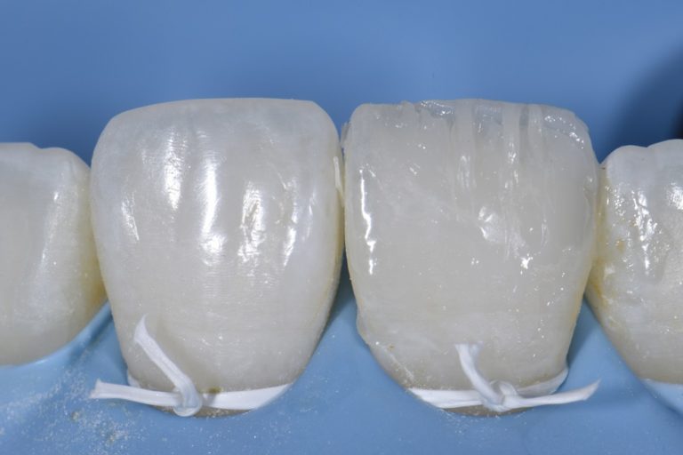 Class IV fracture freehand repair with Kerr Harmonize composite resin