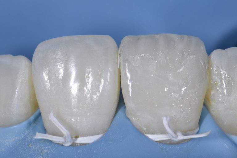 Class IV fracture freehand repair with Kerr Harmonize composite resin