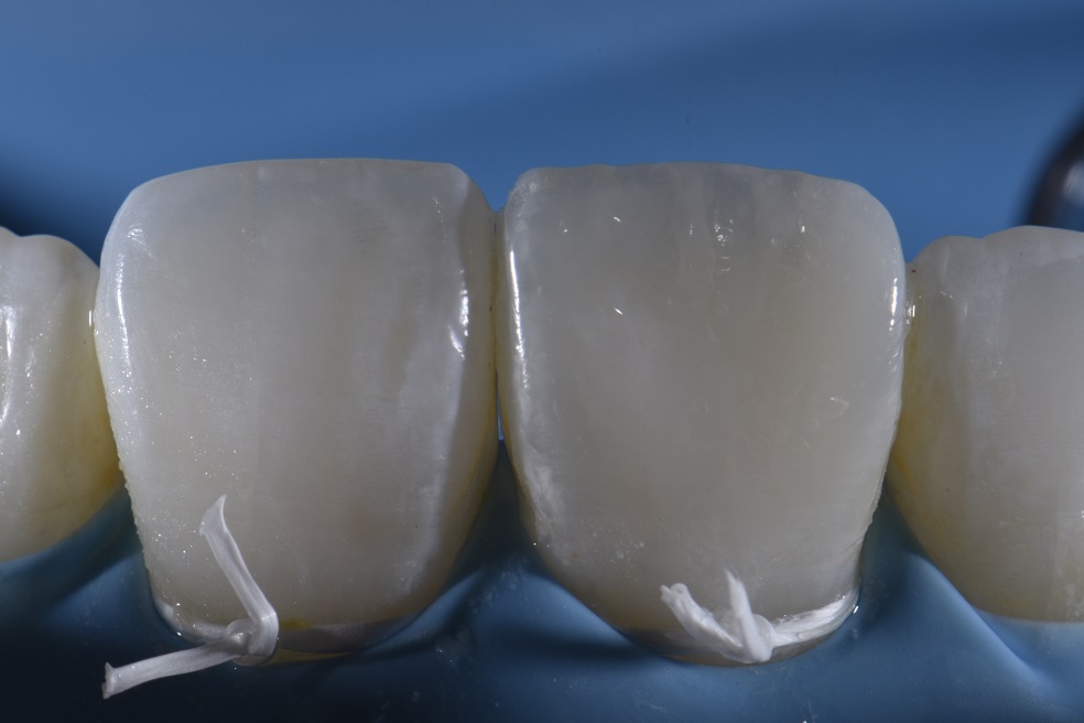 Class IV fracture freehand repair with Kerr Harmonize composite resin
