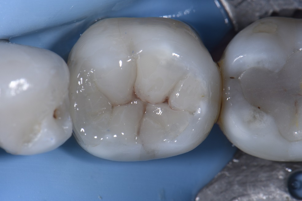 Replacing Porcelain Inlays with Direct Composite