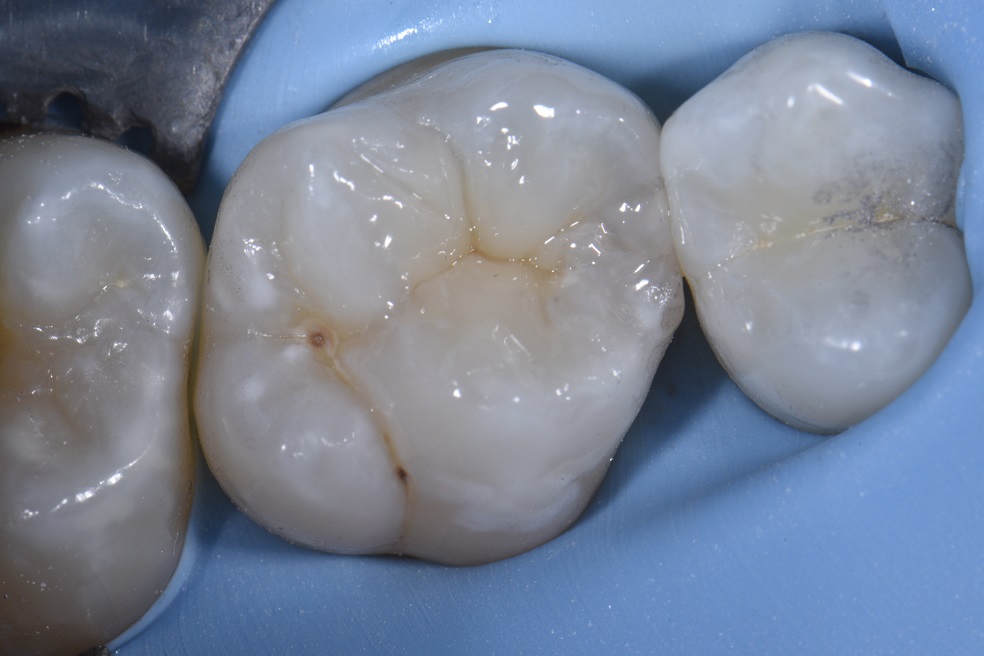 Amalgam replacement for a young dentist