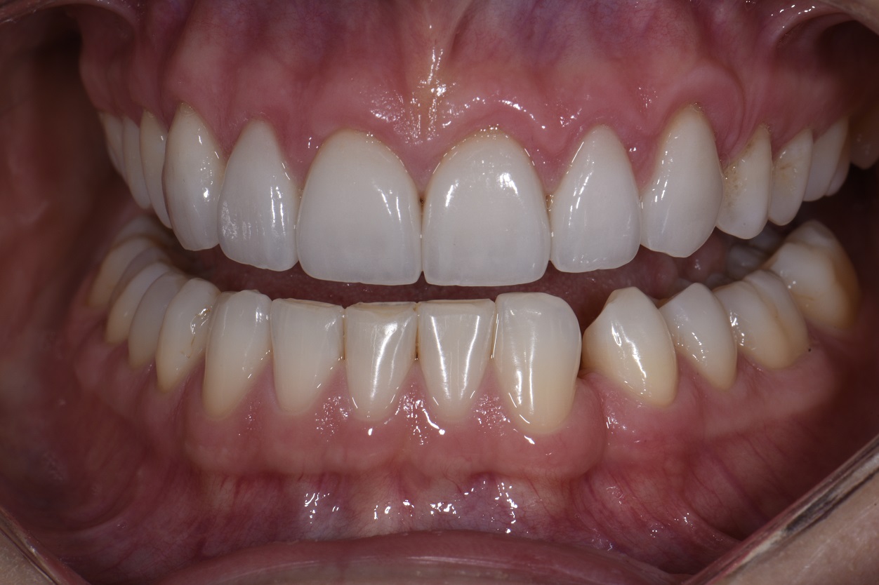 Corrective Esthetics using Digital Smile Design Smile Designer Pro