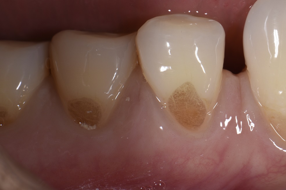 GC Essentia Restorations on Cervical Abrasion Lesions