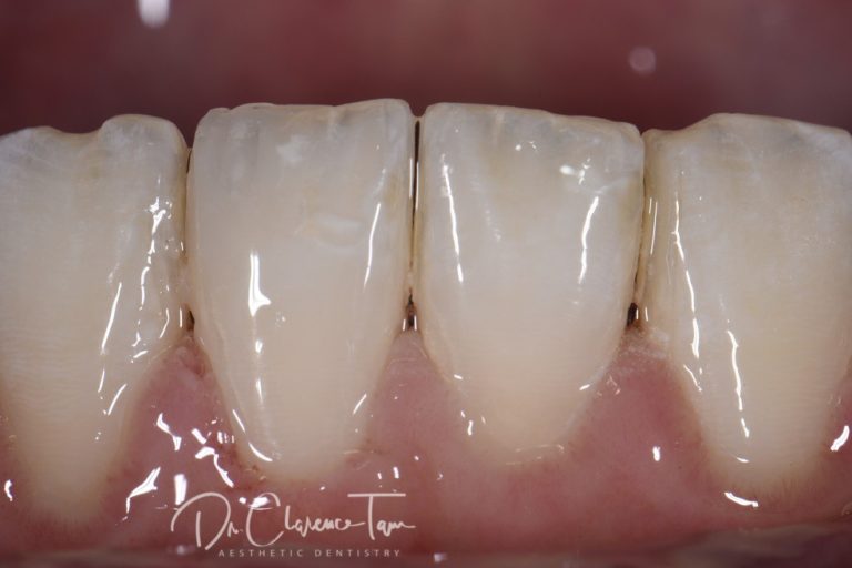 Enamel chips in a lower incisor