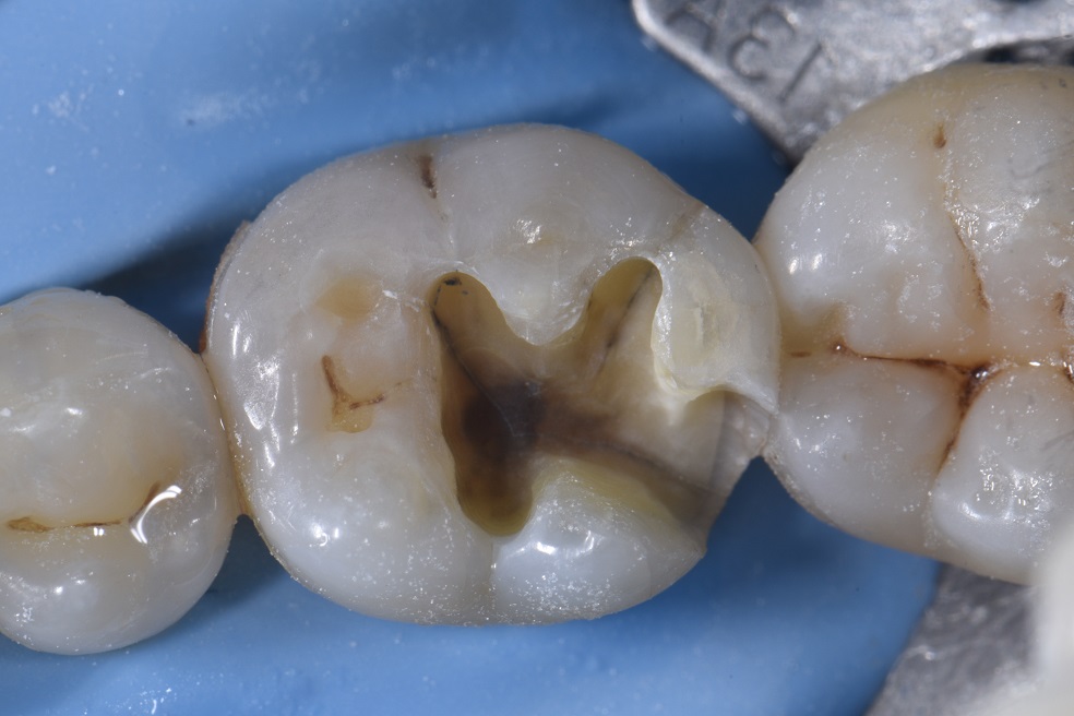 Stabilizing Cracks in Amalgam-Filled Teeth