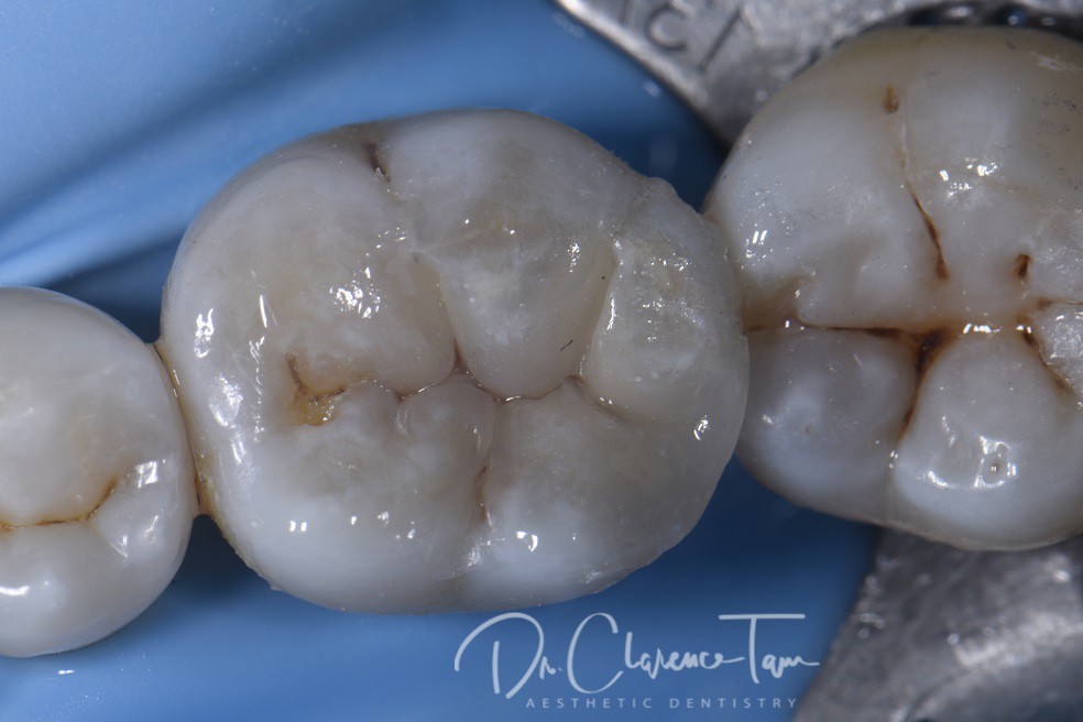 Stabilizing Cracks in Amalgam-Filled Teeth